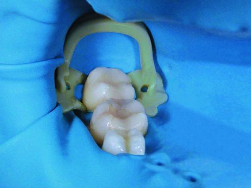 Soft Clamp General Kit 5250, 5 stk- Dental Direct